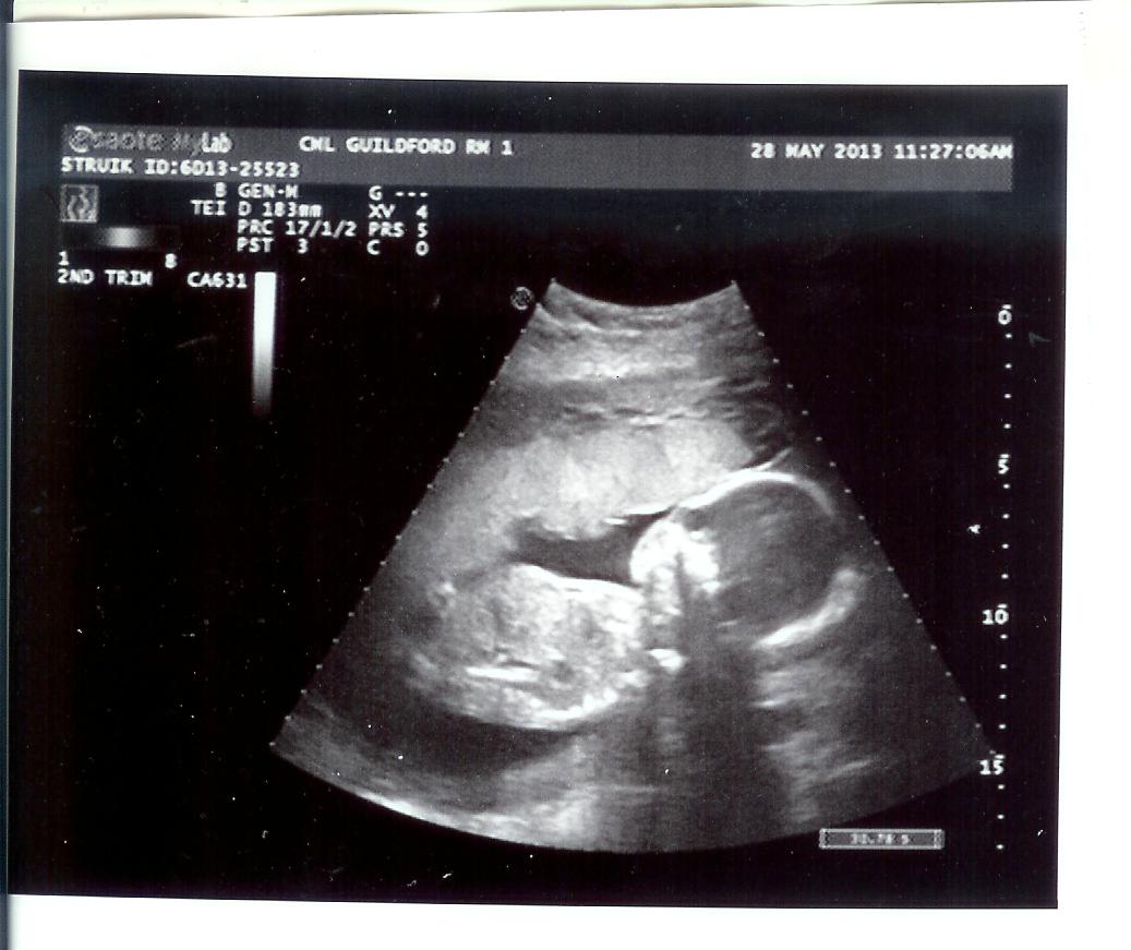 The Struiks: 21 Weeks & Ultrasound #2