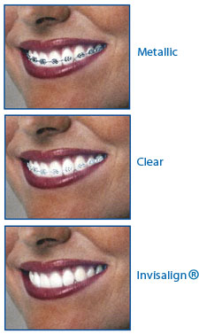 Newman Orthodontics: Orthodontic Treatment: Corrects the Alignment of ...