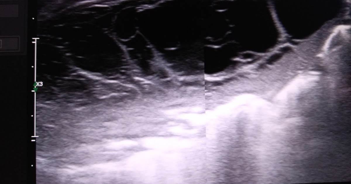 SONO DIGEST: ULTRASOUND CHEST- Empyema thoracis & Enlarged Thymus