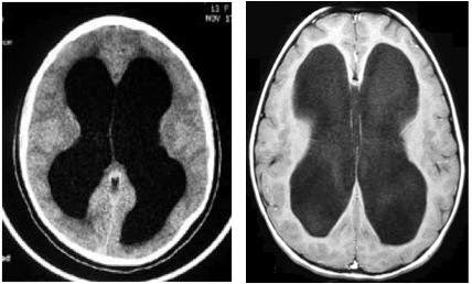 L'hydrocéphalie | Récap' IDE
