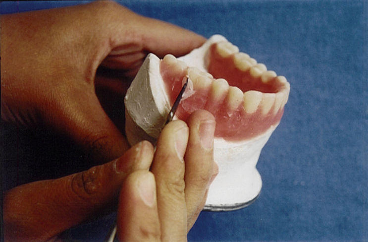 Prostodoncia total: Definición y conceptos de Prostodoncia Total