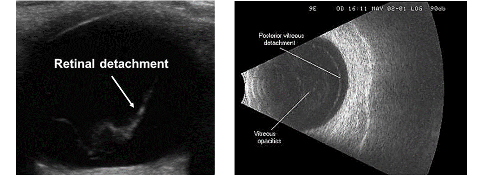 Posterior Vitreous Detachment Ultrasound