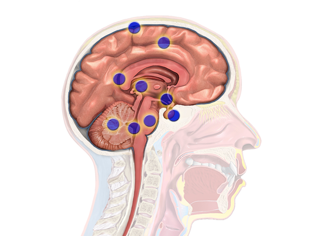 Brain Tumor Cancer Types And Treatment Options
