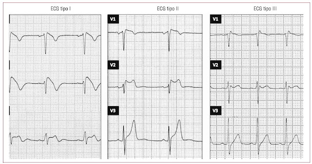 Sindrome Brugada INFO: Síndrome de Brugada