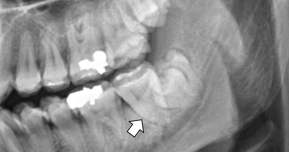 Roentgen Ray Reader: The Lamina Dura
