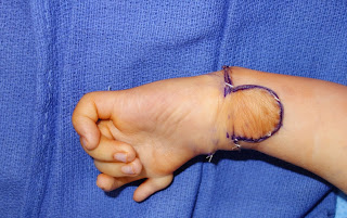 Severe Radial Deficiency- No slowing this kid down! | Congenital Hand ...