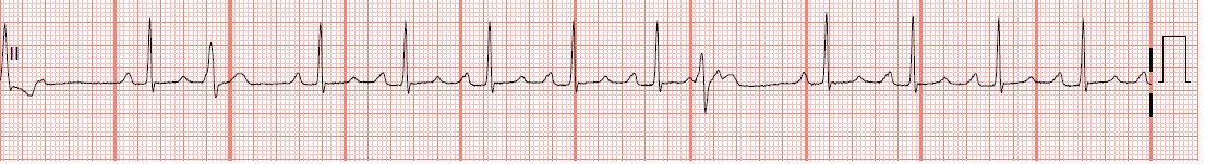 EKG Rhythm Strip Quiz 18