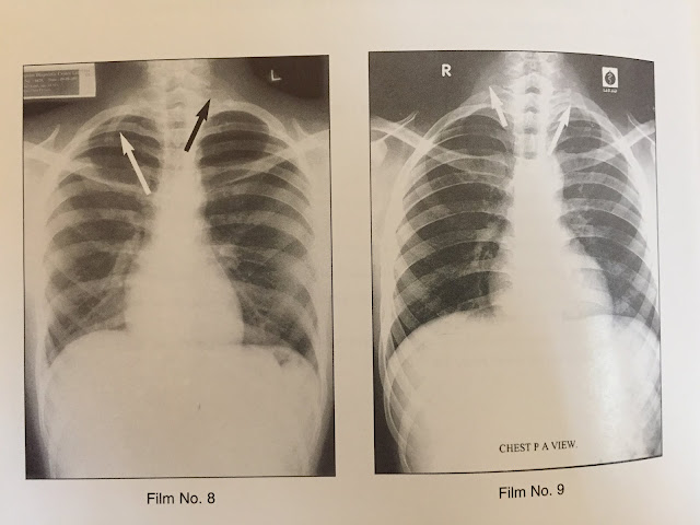 NORMAL VARIANT OF CHEST XRAY
