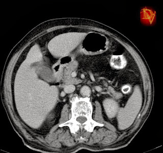 Ultimate Radiology : Duodenal Diverticulum - CT sections
