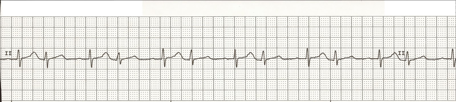 EKG Rhythm Strips 24: Ectopic beats