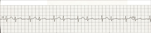 EKG Rhythm Strips 24: Ectopic beats