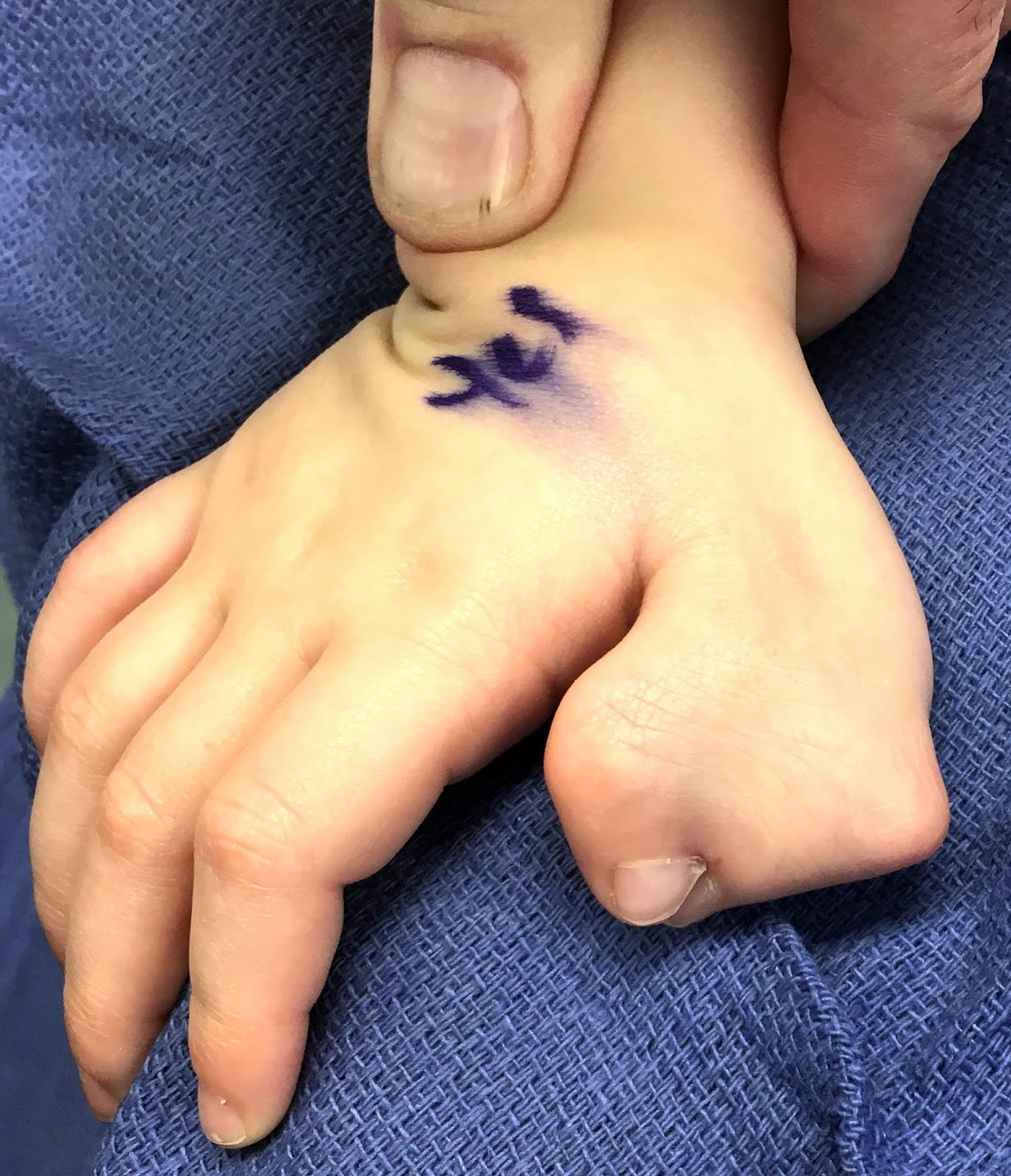 Three thumbs | Congenital Hand and Arm Differences | Washington ...