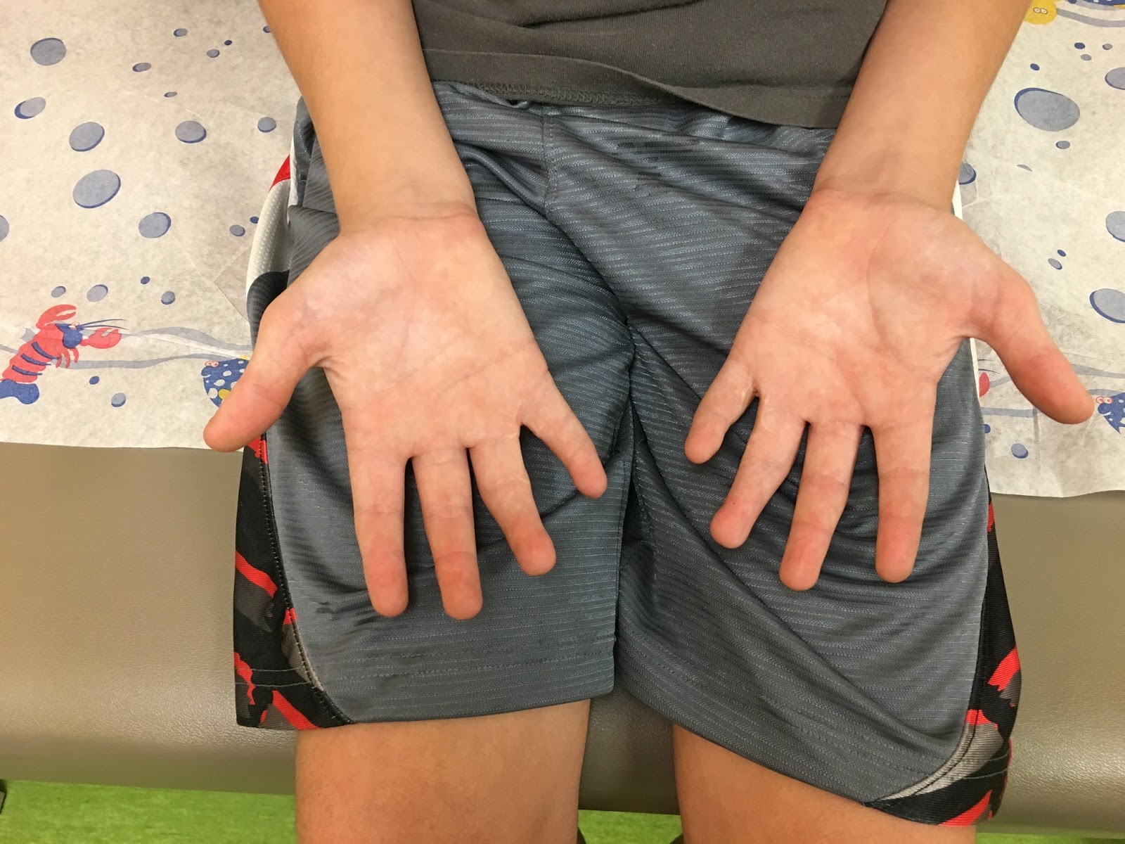 Syndactyly Revision Surgery | Congenital Hand and Arm Differences ...