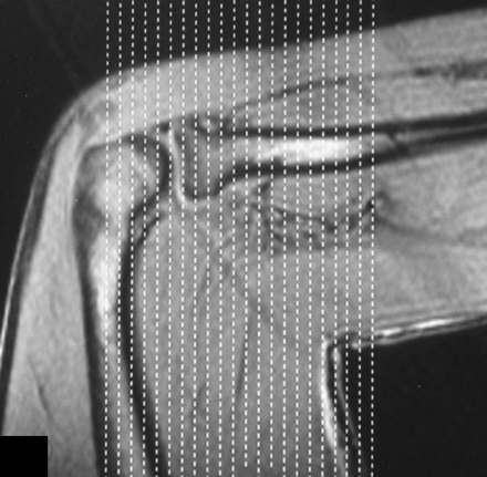 MRI Musculo-Skeletal Section: Biceps injury