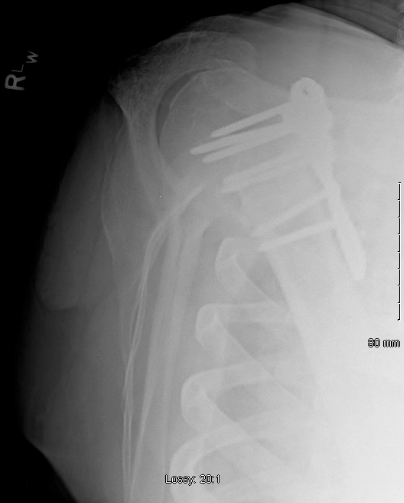 Shoulder and Elbow Surgery: Shoulder subluxation after fixation of ...