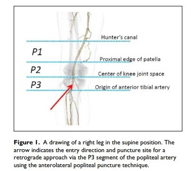 Vascular Mind : ANTEROLATERAL POPLITEAL PUNCTURE TECHNIQUE: A NOVEL ...