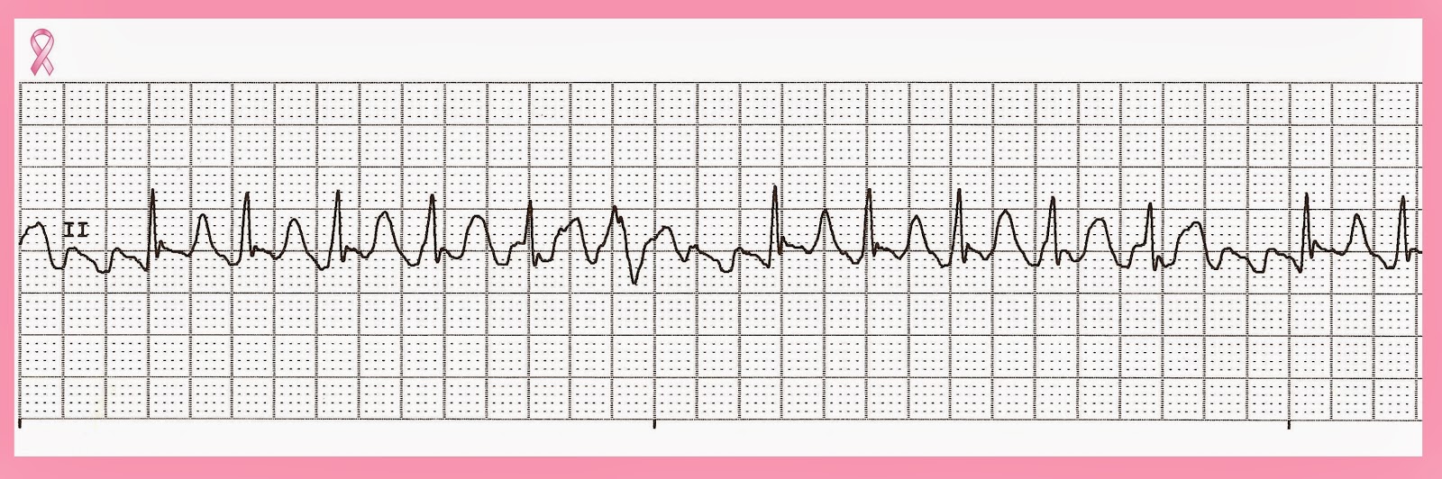 Practice EKG Strips 357