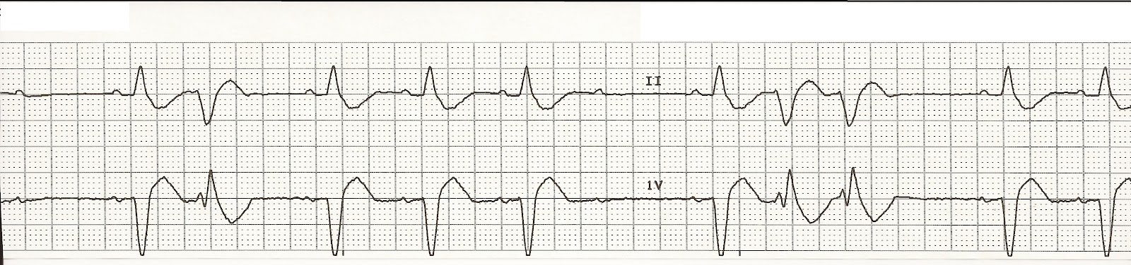 EKG Rhythm Strip Quiz 52: Heart Blocks