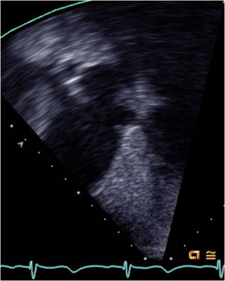 Pedi cardiology: Echo: ASD, TEE evaluation of rims for Transcatheter ...