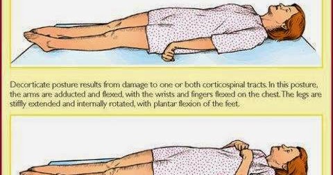 Comparison between Decerebrate and Decorticate postures ~ Flash Medical