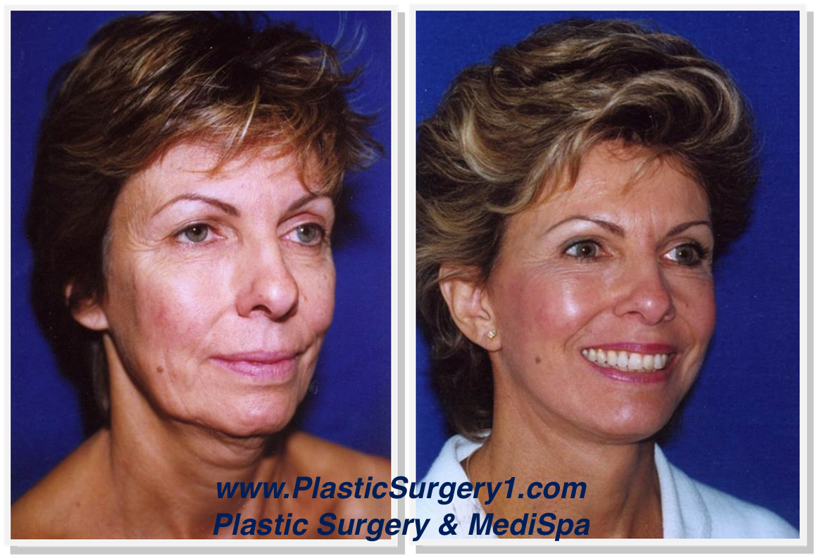 Recapture That Youthful Spark - Mini-Lift : Doctor Brett Stompro - Dr ...