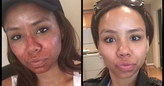 PRP | The anti-aging vampire facial that can also grow your hair ...