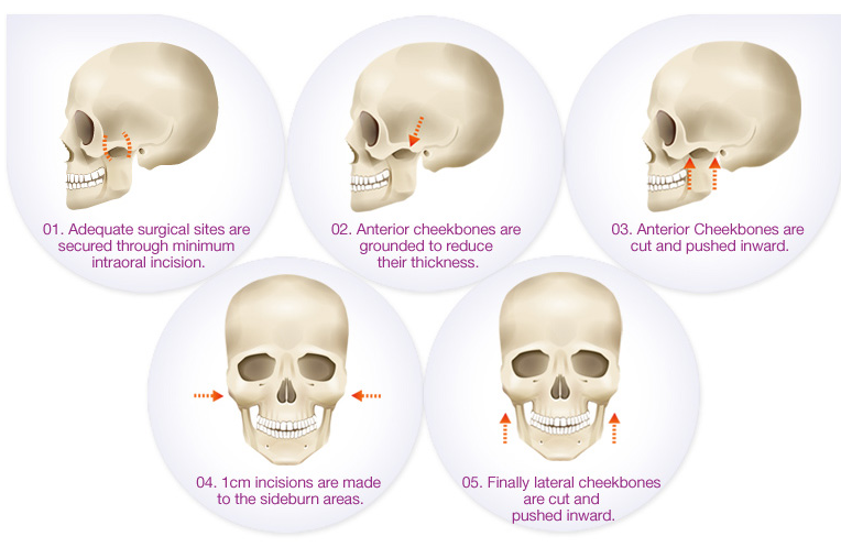 BK Plastic Surgery: [BK Plastic Surgery] 3D Cheekbone Reduction