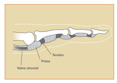Un Médico Online: DEDO EN RESORTE - DEDO EN GATILLO - TENOSINOVITIS ...