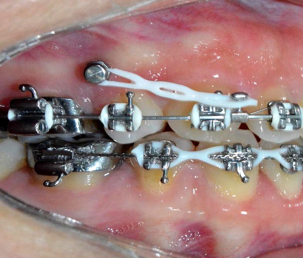 ORTODONCIA : Colocación de microimplantes en ortodoncia - Paso a paso