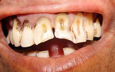 u.S.o: Sports And Energy Drinks Damage Teeth- Report