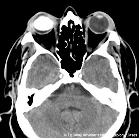 Dr Balaji Anvekar FRCR: Intraocular silicon gel CT