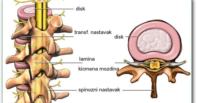 DISKUS HERNIJA: Diskus hernija