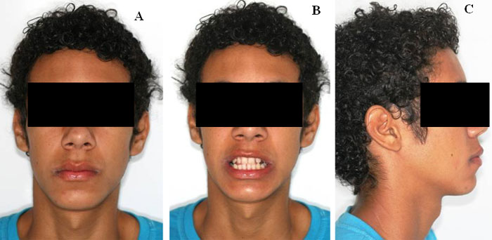 MORFOLOGIA OCLUSAL: CLASIFICACION DE ANGLE