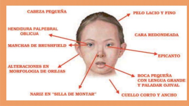 Sindrome de Noonan: 2016
