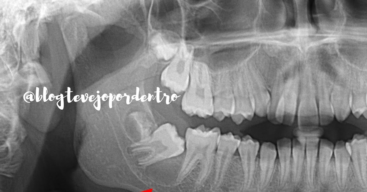 "Te vejo por dentro": E o dente 47?