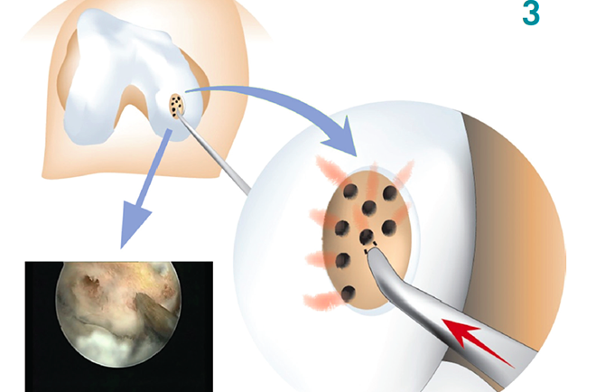 Shoulder Arthritis / Joint Replacement : Microfracture - what can we say?