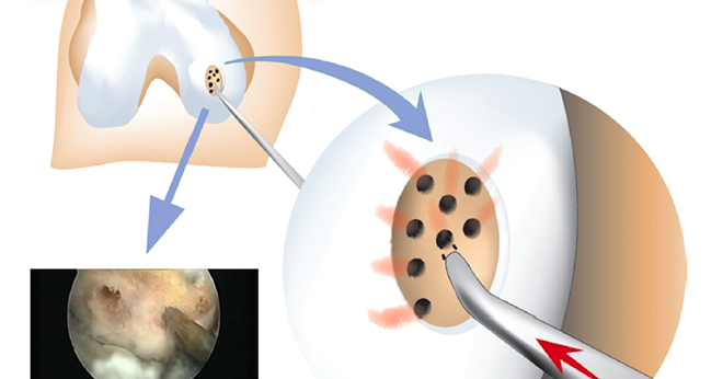 Shoulder Arthritis / Joint Replacement : Microfracture - what can we say?