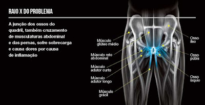 Goleiro Laércio Buranello: Lesão e tratamento da pubalgia.