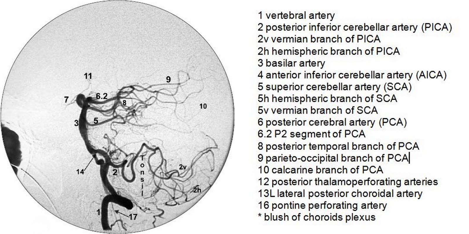Doctor Man's Blog: 腦血管造影 (DSA cerebral angiogram)