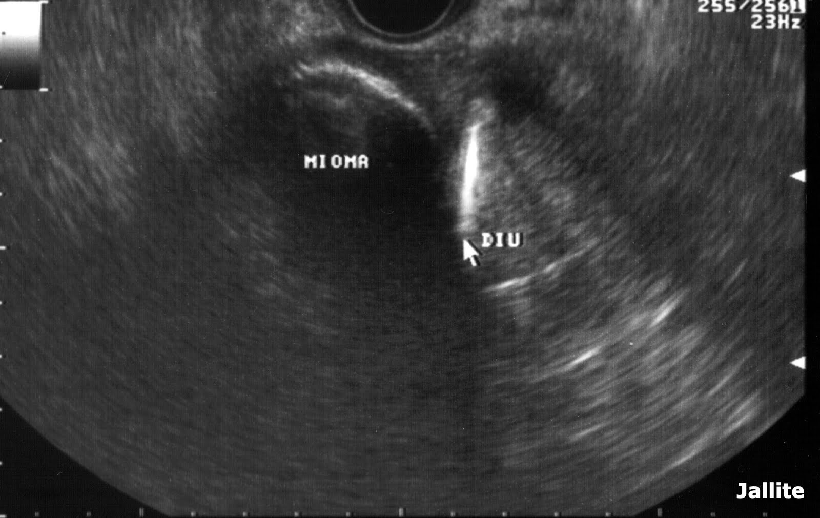 Mioma Calcificado y DIU