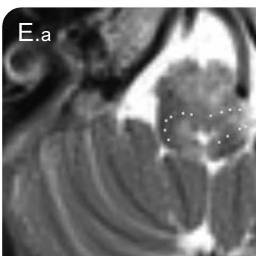 pediatric neurology: The human sneeze center
