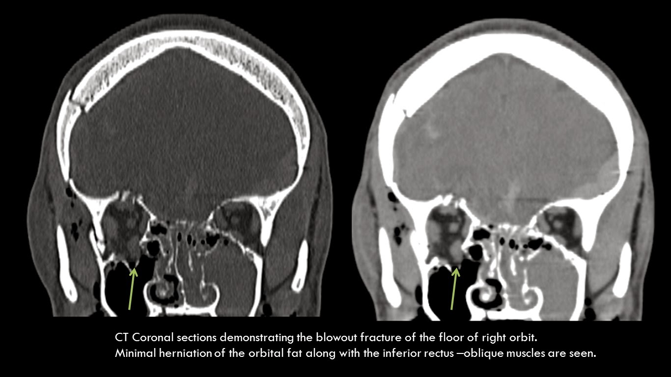 Ultimate Radiology : Orbital Blow-out Fractures