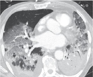 Paciente Grave: PEEP na SDRA: fisiologia e evidências