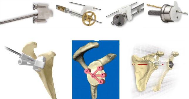 UW Shoulder and Elbow Academy: Three Dimension Pre-Operative Planning ...