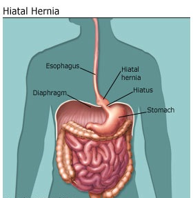 Hiatus Hernia: Hernia hiatus hernia as well as for finest do-it ...