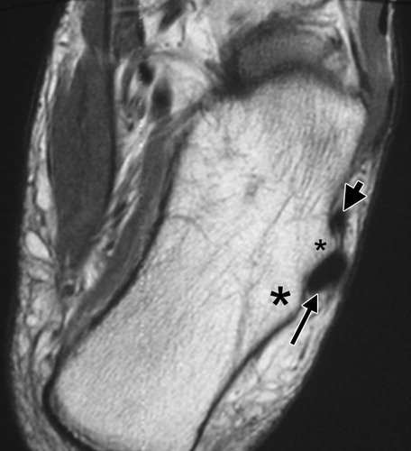 MRI Musculo-Skeletal Section: Peroneal tendon lesions.