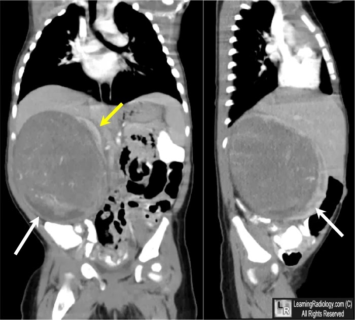 Medical Treatment Pictures-for Better Understanding: Wilms' Tumor