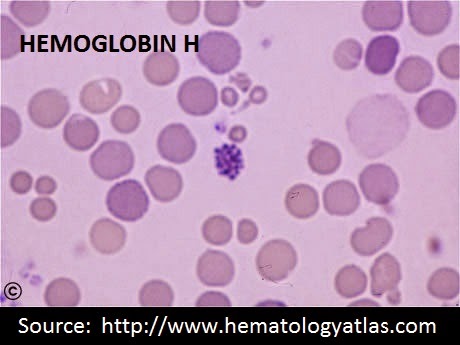 Lab Atlas: Hemoglobin H