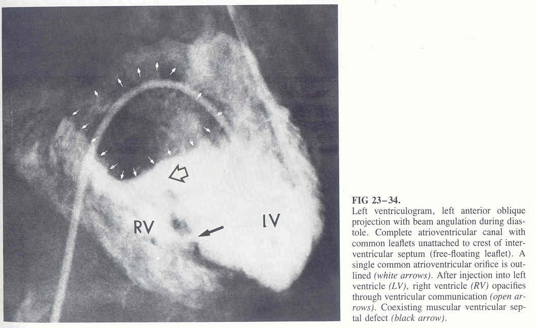 Pedi cardiology: Cath: Angiogram of AVSD, Inlet VSD