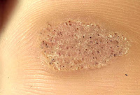 Plantar Warts Treatment